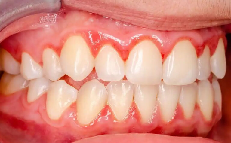 Learn How to Treat Gingivitis: A Comprehensive Guide