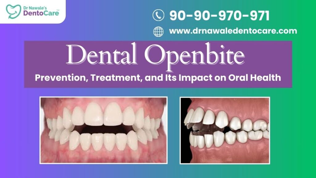 Dental Open Bite: Symptoms, Treatment and Impact on Health